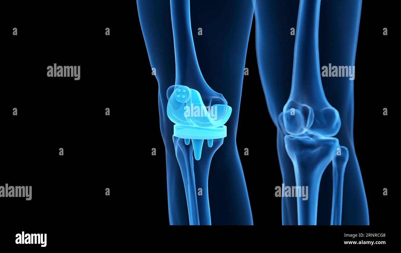 Knee replacement, illustration Stock Photo - Alamy