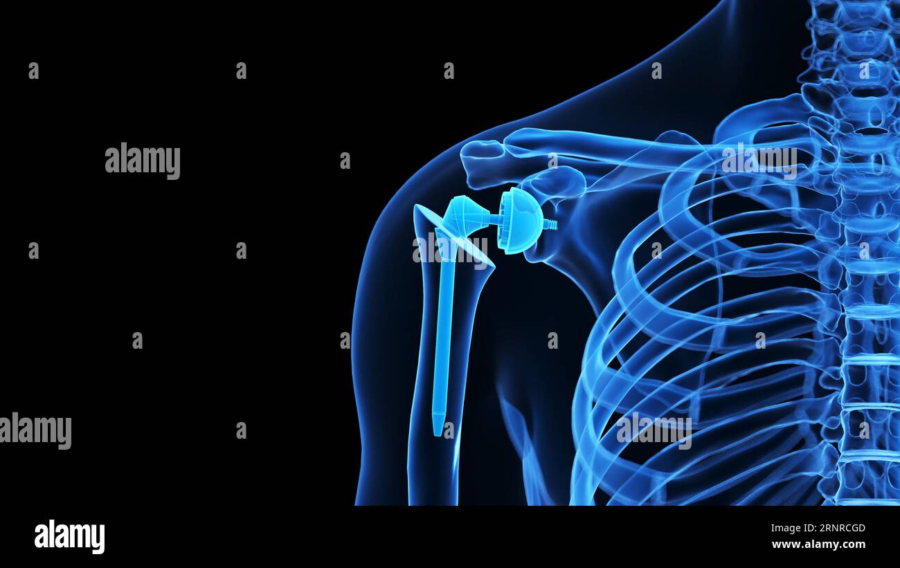 Shoulder replacement, illustration Stock Photo - Alamy