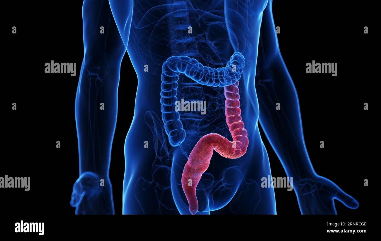 Ulcerative colitis, illustration Stock Photo - Alamy
