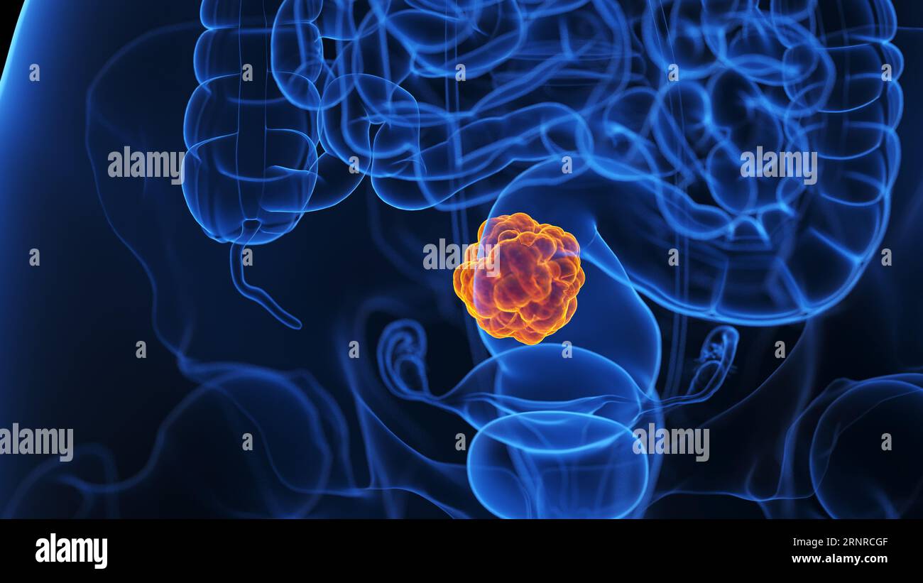 Colon cancer, illustration Stock Photo - Alamy