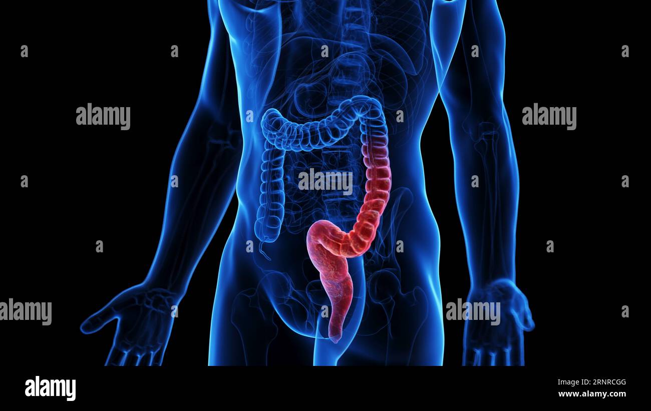 Ulcerative colitis, illustration Stock Photo - Alamy