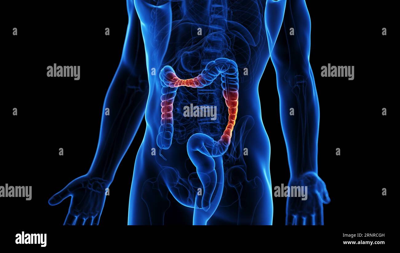 Inflammatory bowel disease, illustration Stock Photo - Alamy