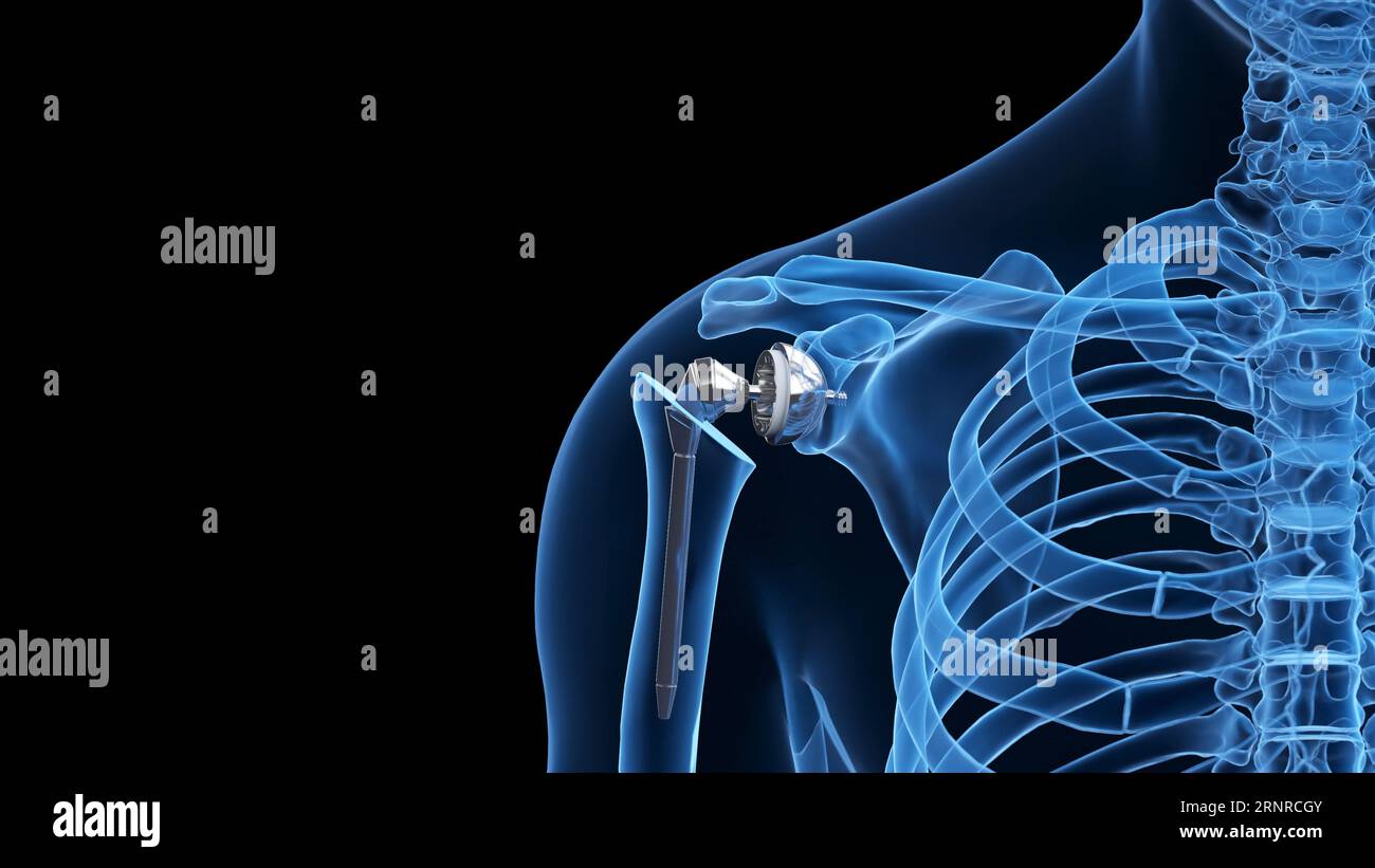 Shoulder replacement, illustration Stock Photo - Alamy