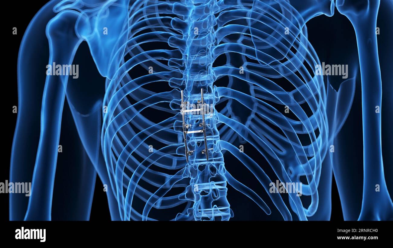 What Are Fused Vertebrae at Patricia Peralta blog
