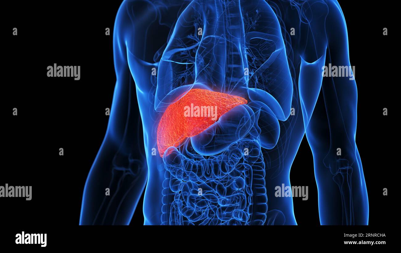 Inflamed liver, illustration Stock Photo - Alamy