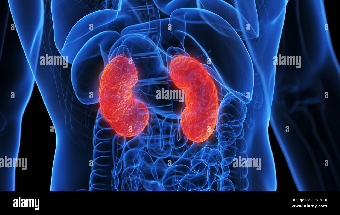 Inflamed kidneys, illustration Stock Photo - Alamy