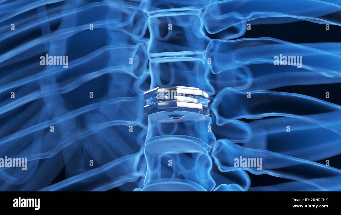 Disc replacement, illustration Stock Photo - Alamy