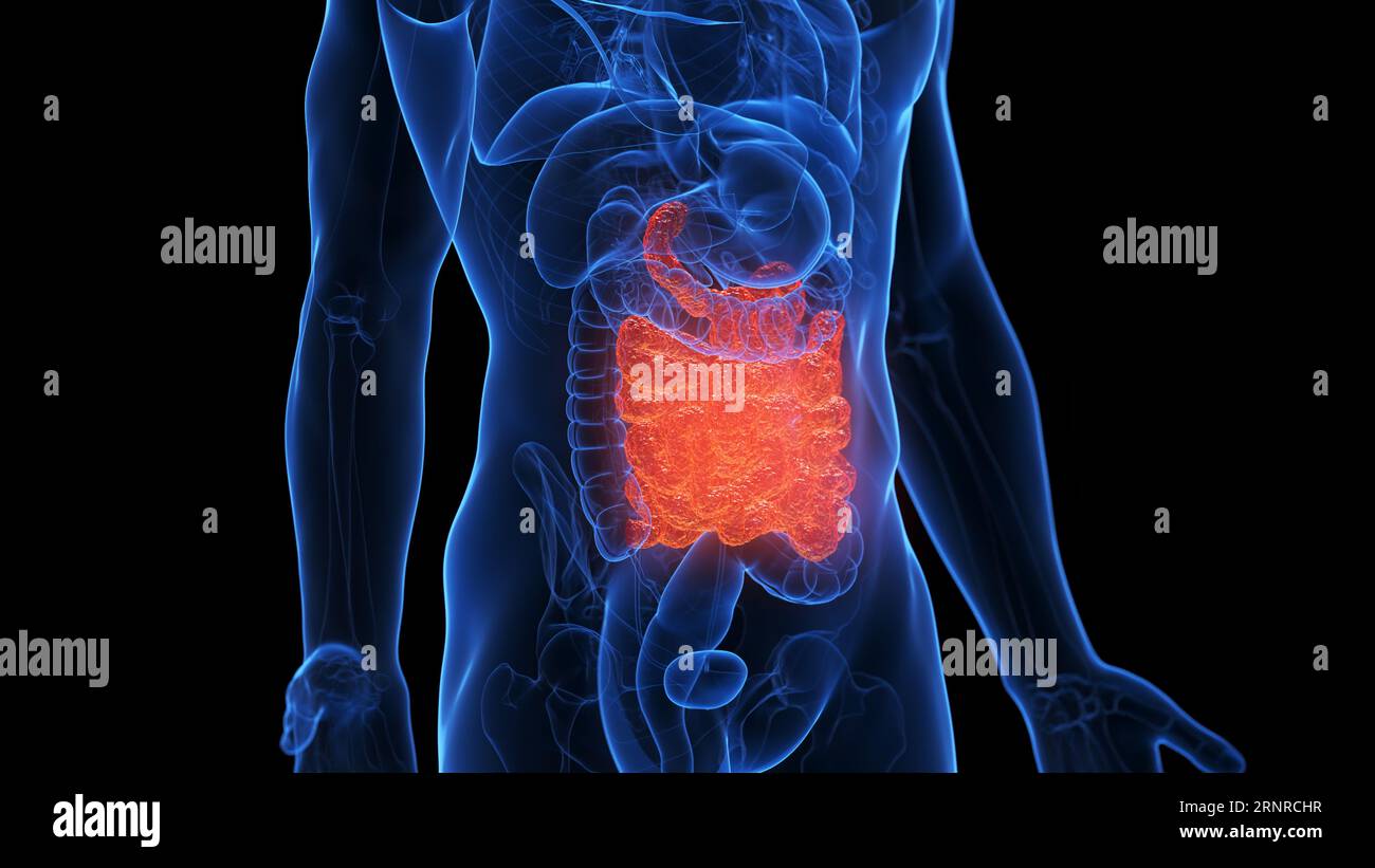 Inflamed small intestine, illustration Stock Photo - Alamy