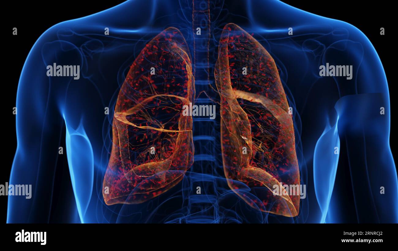 Lung infection, illustration Stock Photo - Alamy