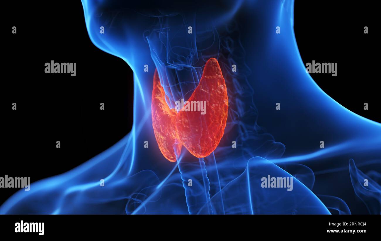 Inflamed thyroid gland, illustration Stock Photo - Alamy