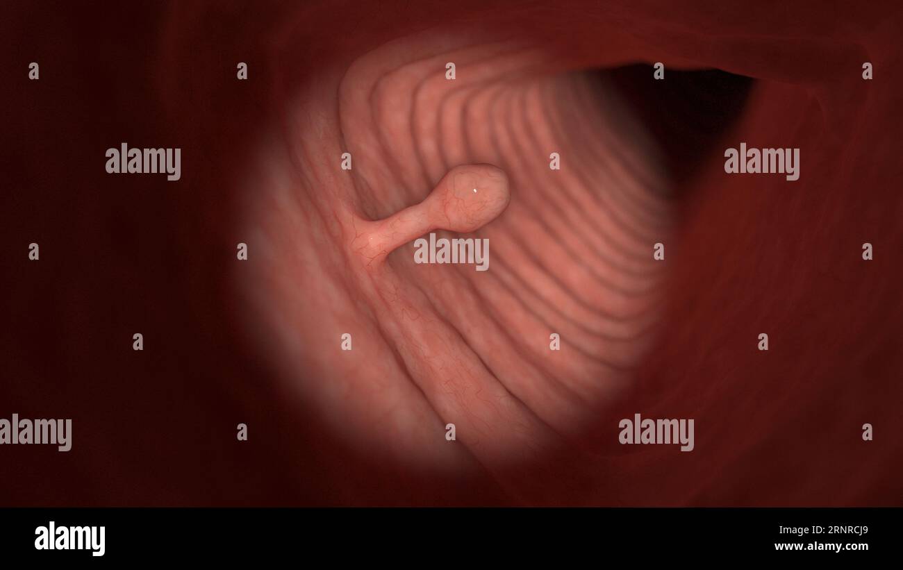 Colon polyp artwork hi-res stock photography and images - Alamy