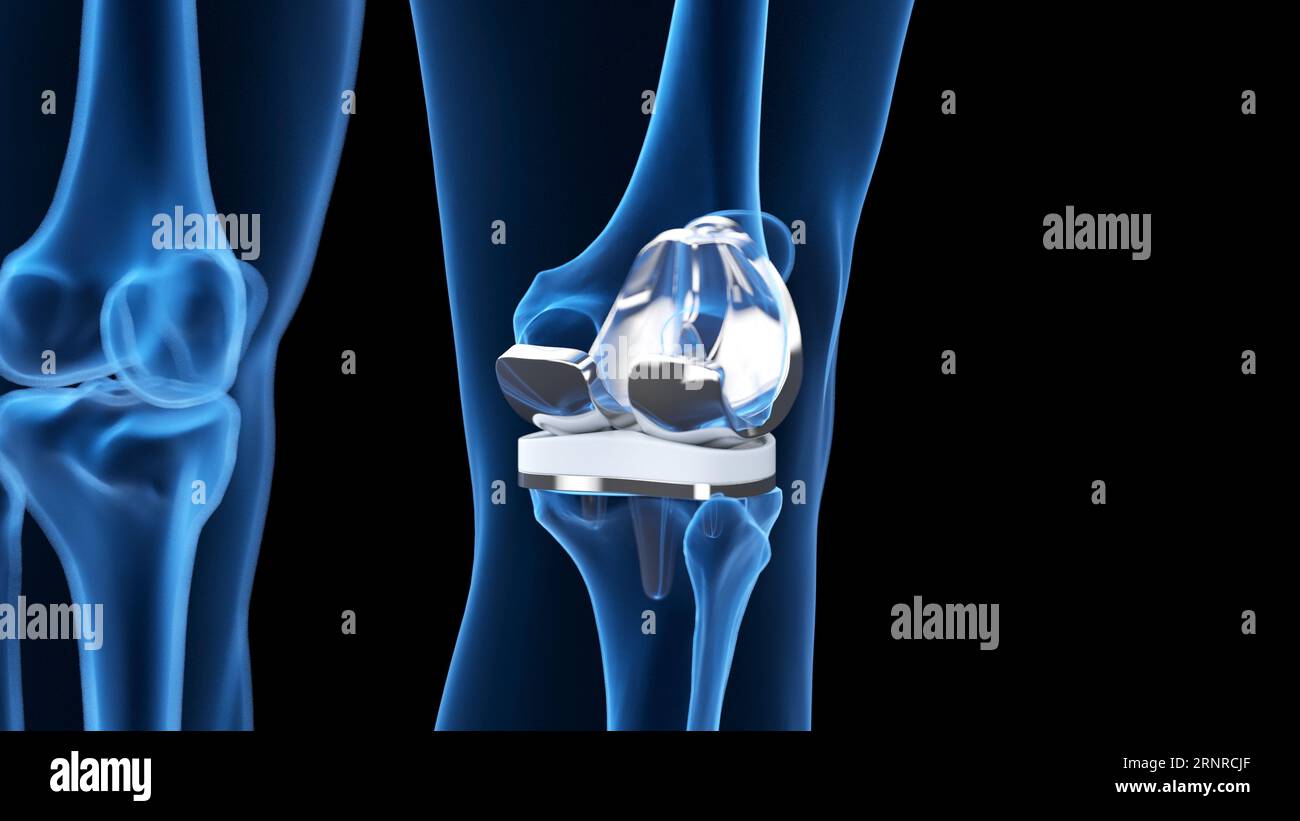 Knee prosthesis titanium joint hi-res stock photography and images - Alamy