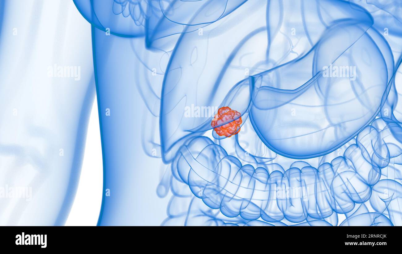 Gallbladder cancer, illustration Stock Photo - Alamy