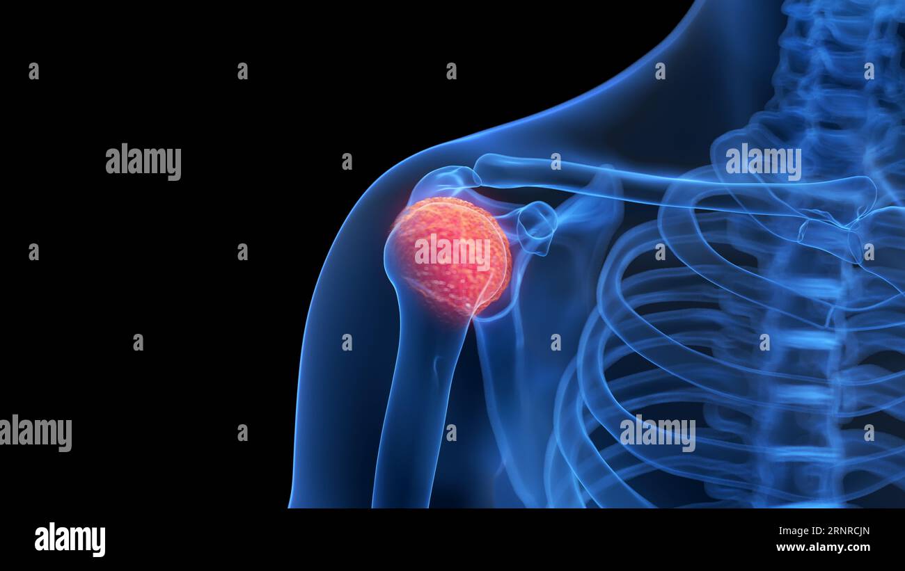 Arthritic shoulder joint, illustration Stock Photo - Alamy