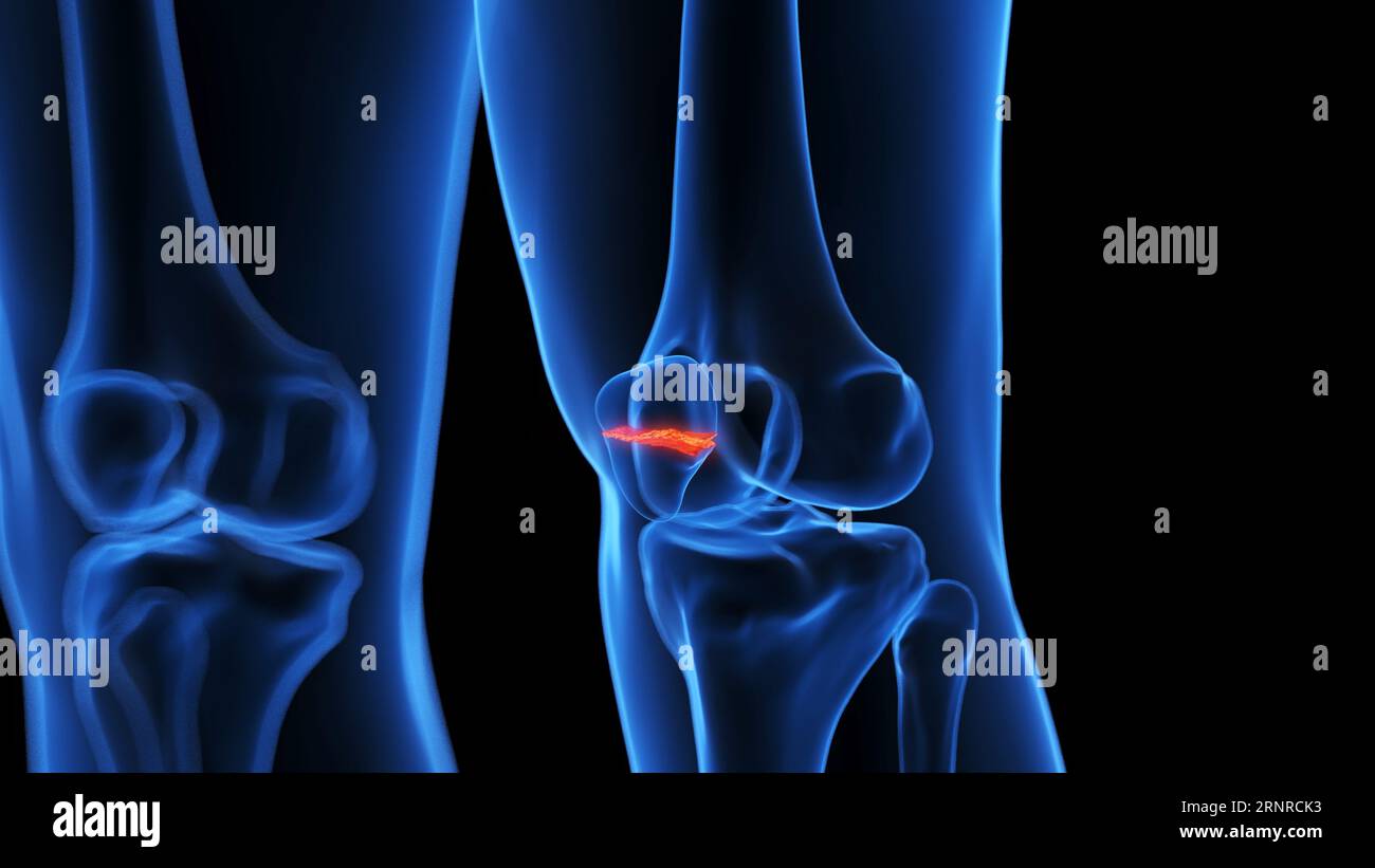 Broken patella, illustration Stock Photo - Alamy