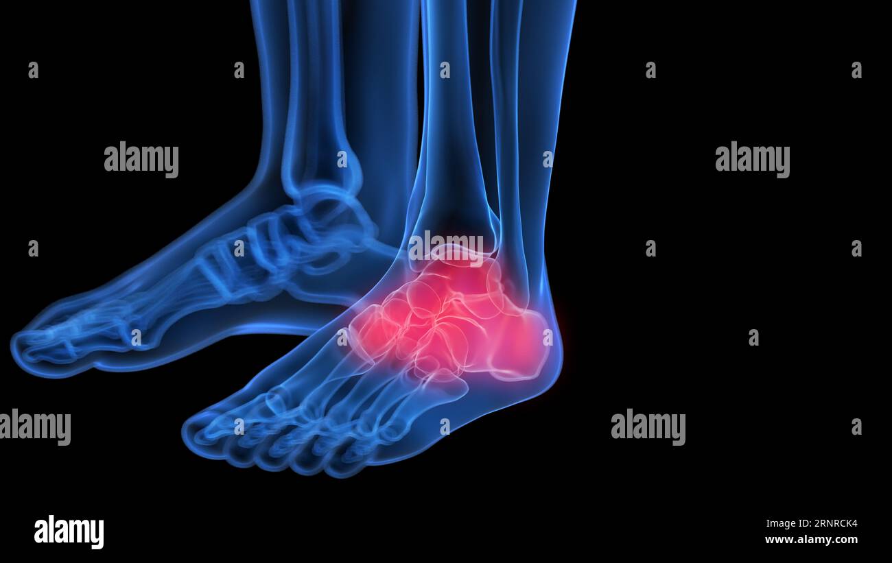 Painful ankle, illustration Stock Photo - Alamy