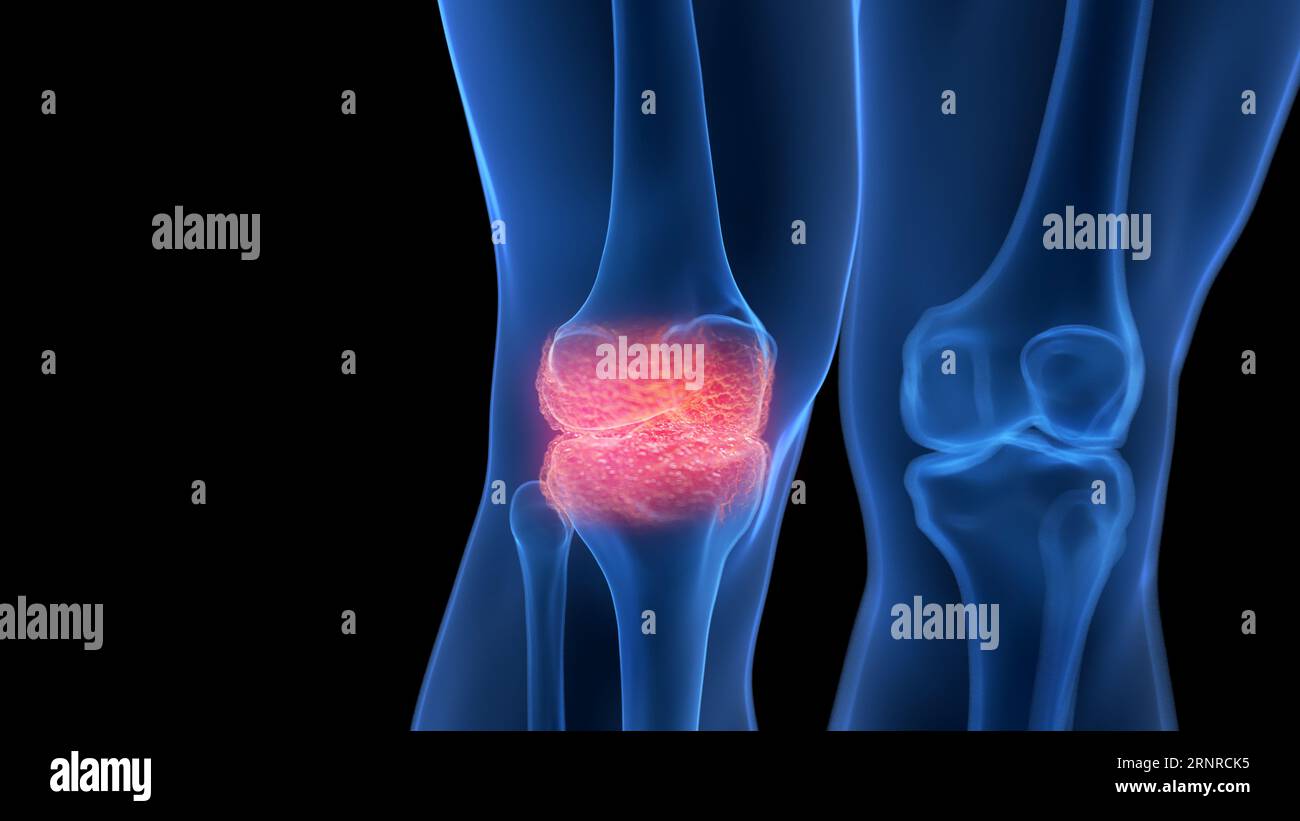 Arthritic knee joint hi-res stock photography and images - Alamy