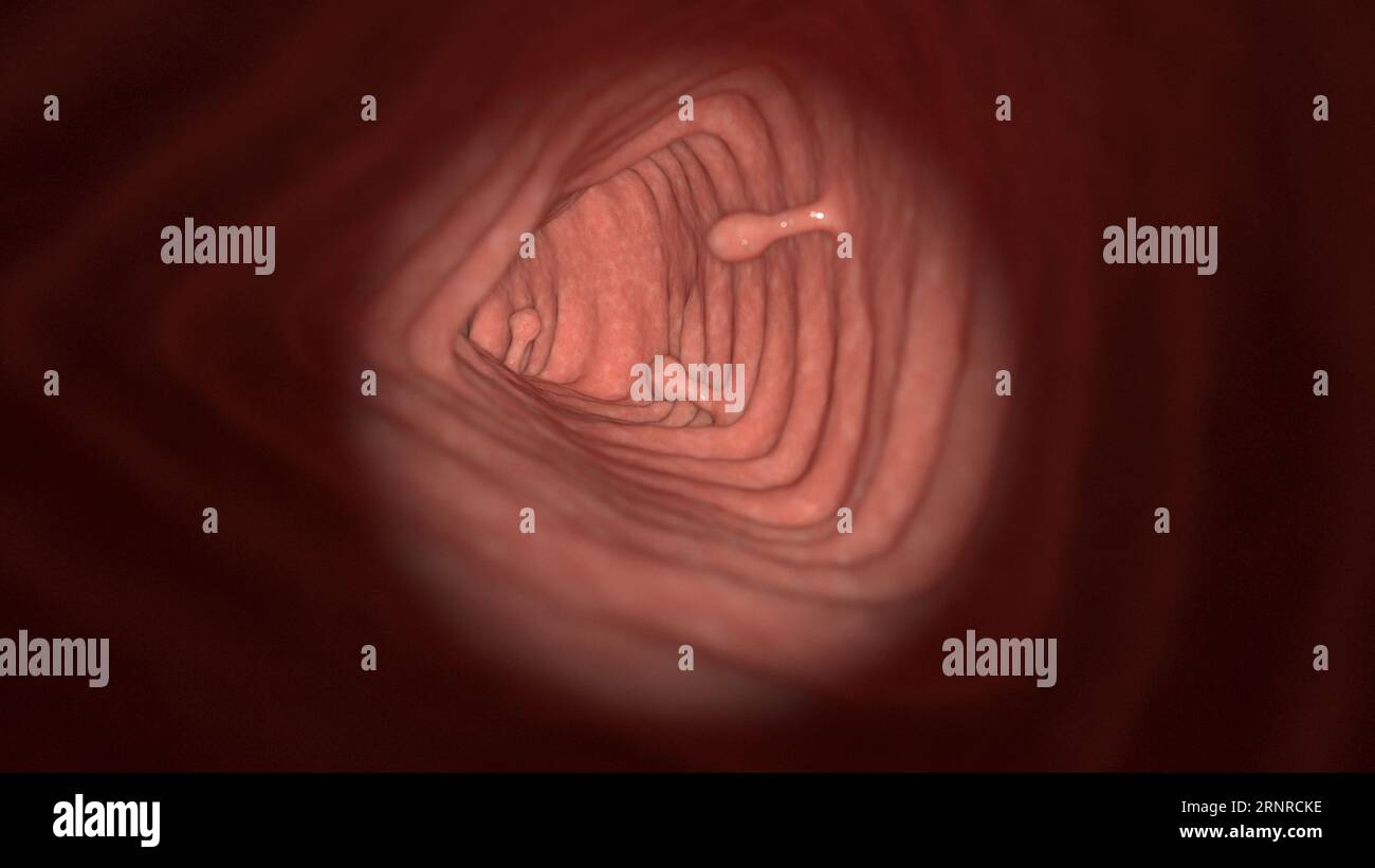 Colon polyps, illustration Stock Photo - Alamy