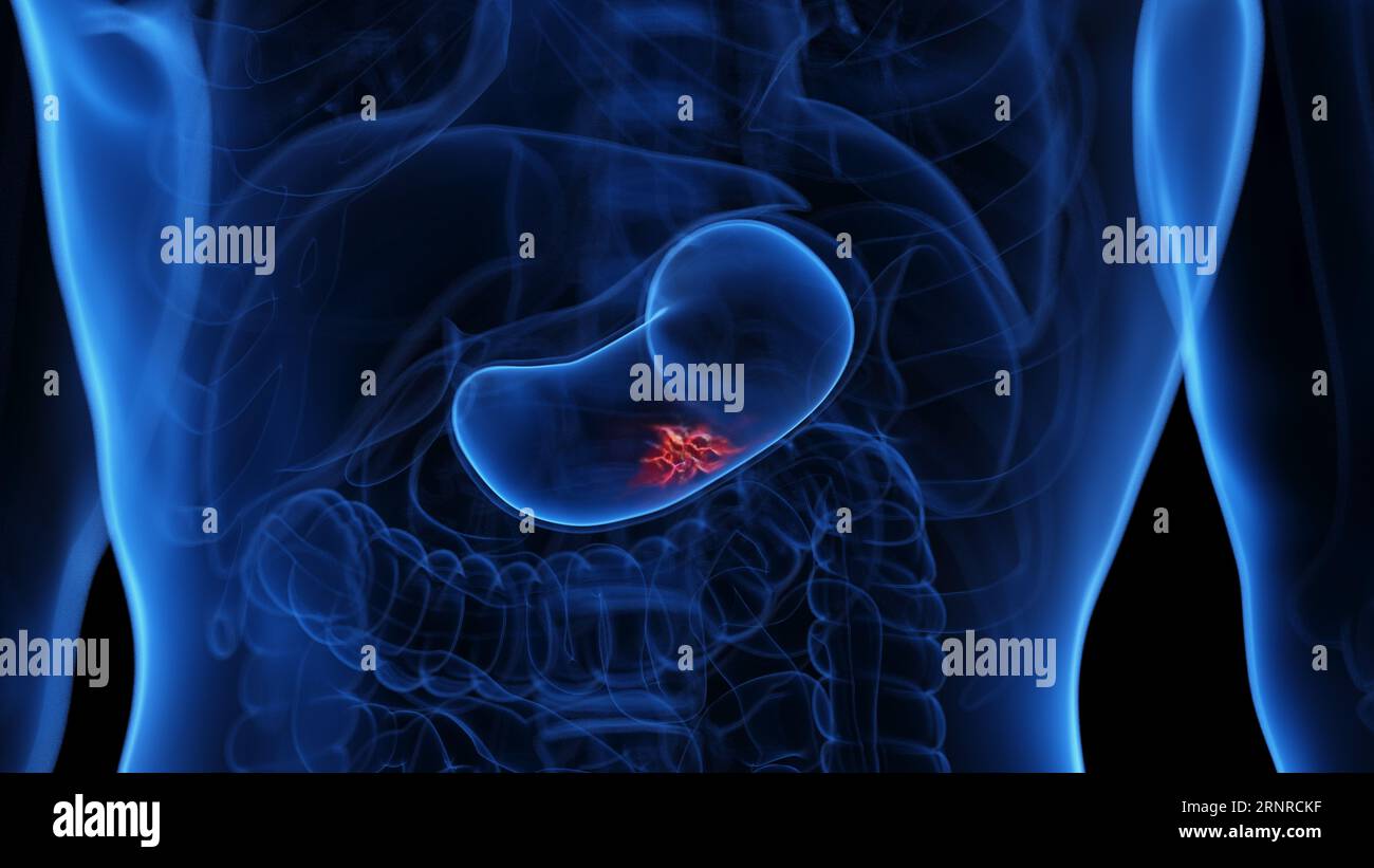 Stomach ulcer, illustration Stock Photo - Alamy