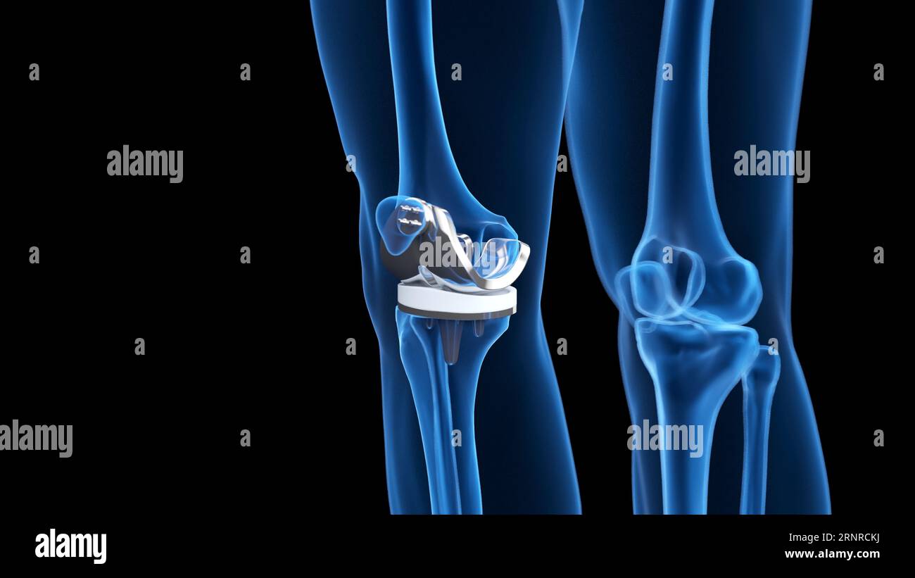 Knee prosthesis titanium joint hi-res stock photography and images - Alamy