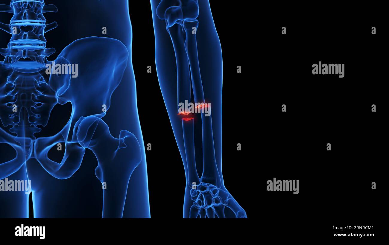 Broken lower arm, illustration Stock Photo - Alamy