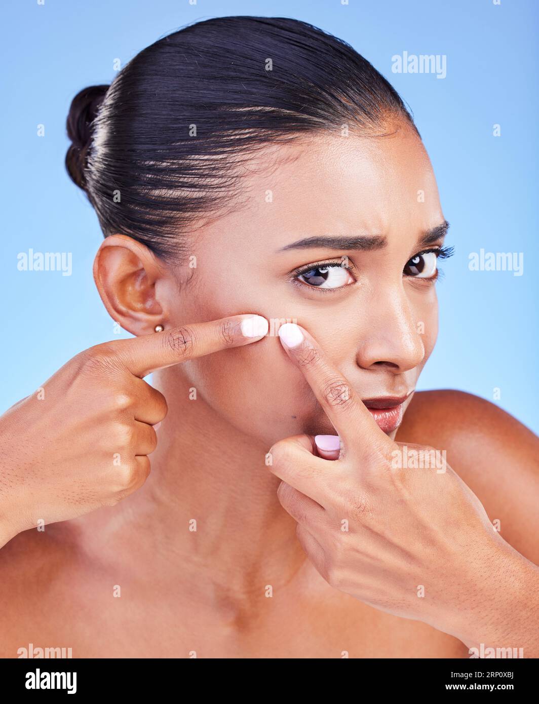 Acne, problem and portrait of woman with pimple in studio for cosmetic ...