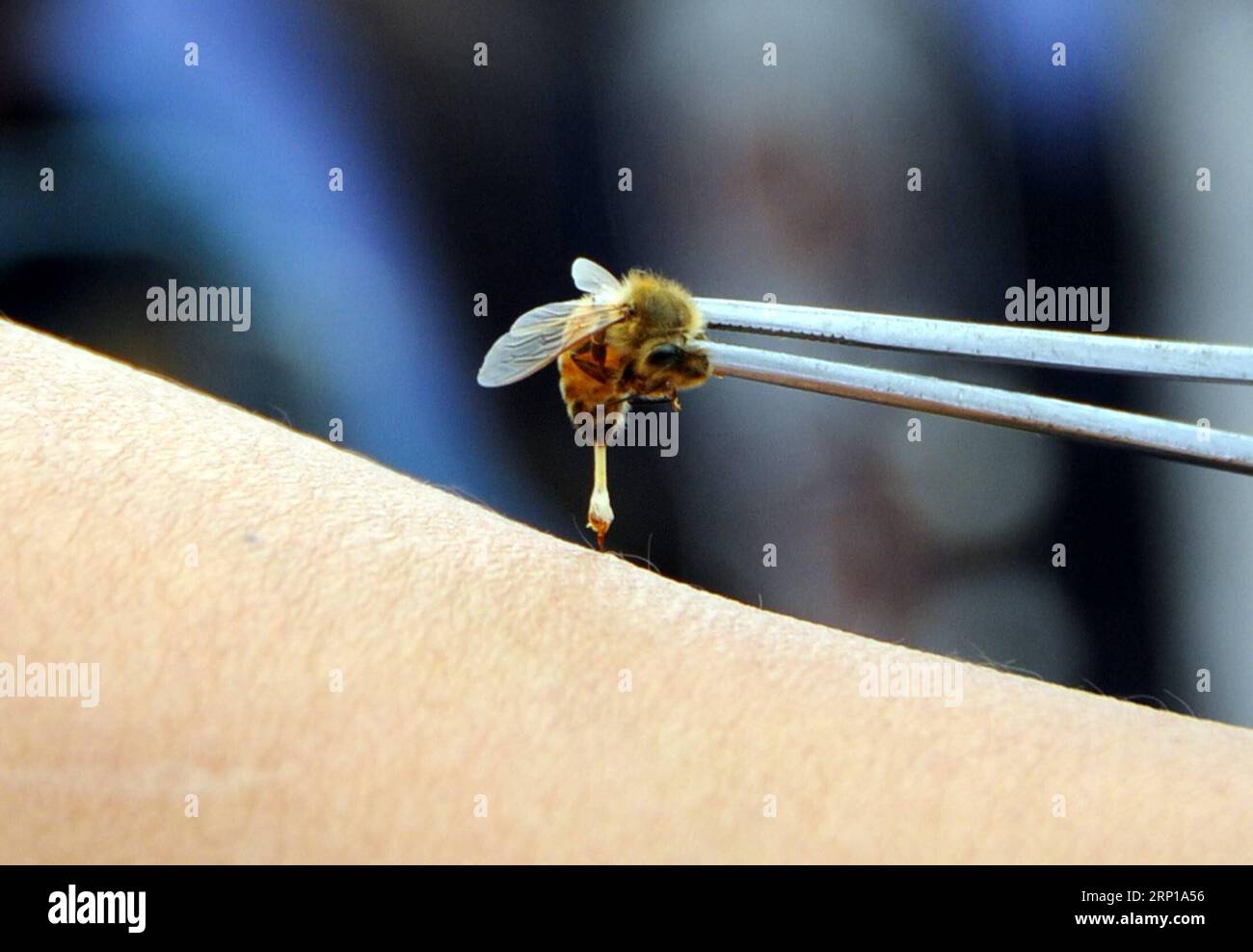 Bee sting therapy hi-res stock photography and images - Alamy