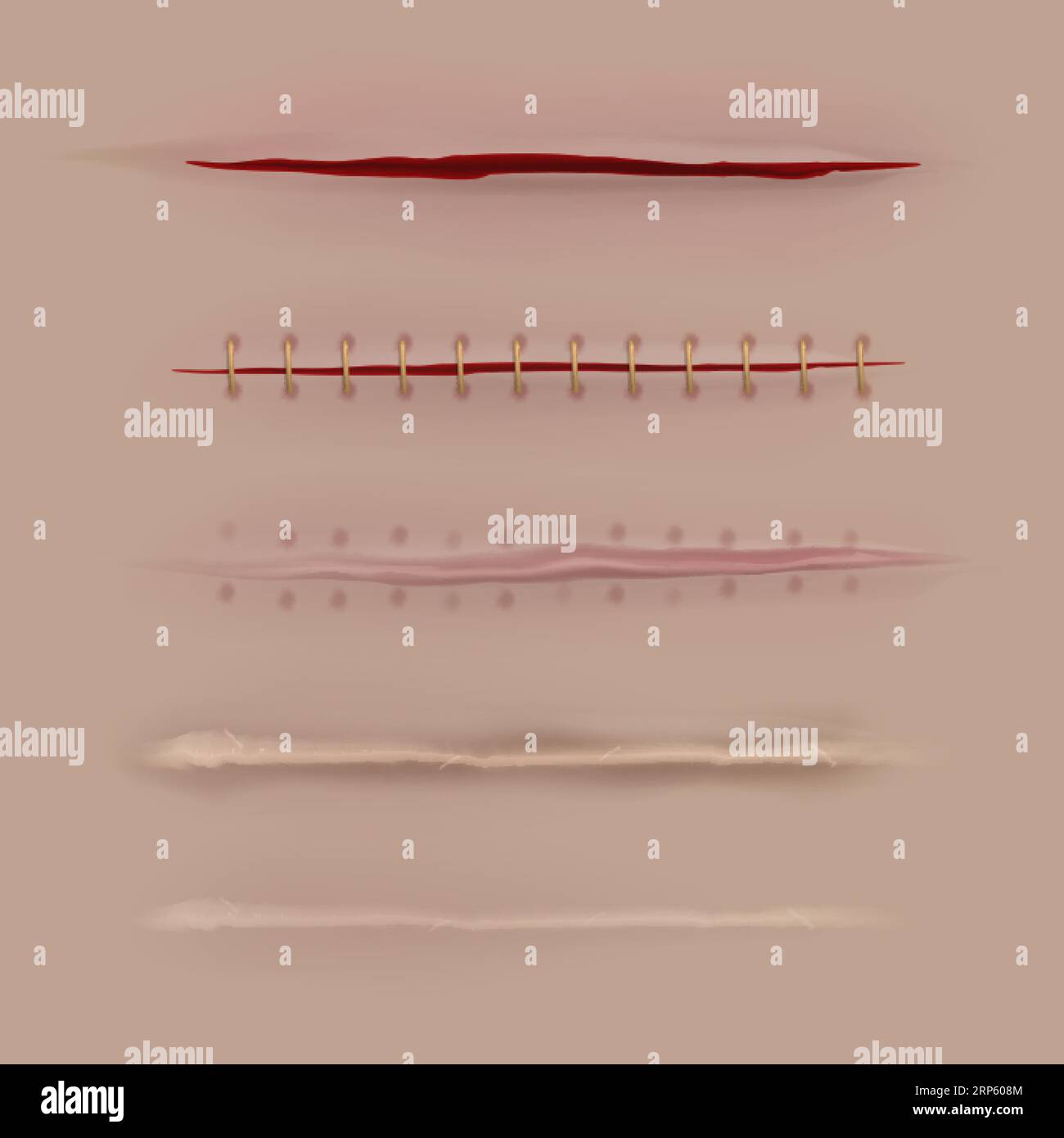 Stitch wound Stock Vector Images - Alamy