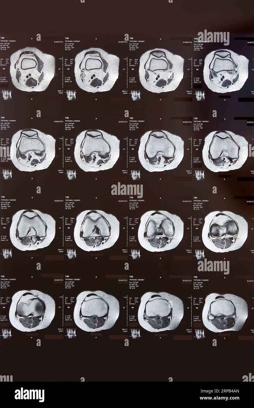 Knee magnetic resonance imaging. MRI diagnosis. Health care Stock Photo ...