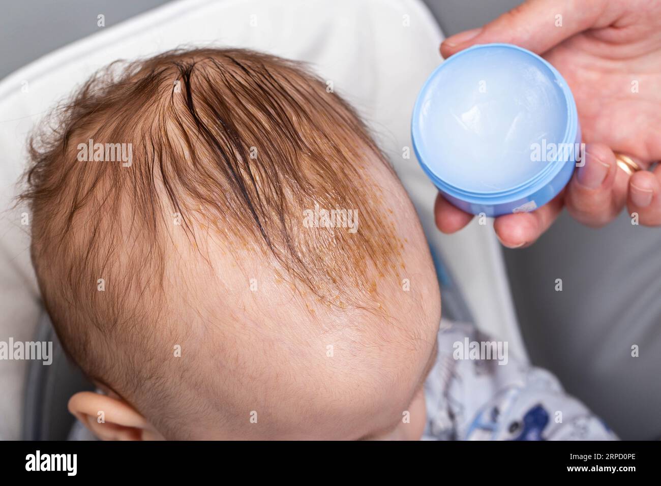 Smearing a seborrheic crust with baby oil on a child's head. Combing ...