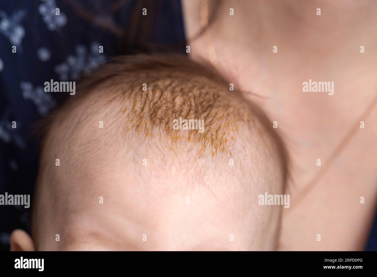 Seborrheic dermatitis on the skin on the head of a 6 month old baby ...