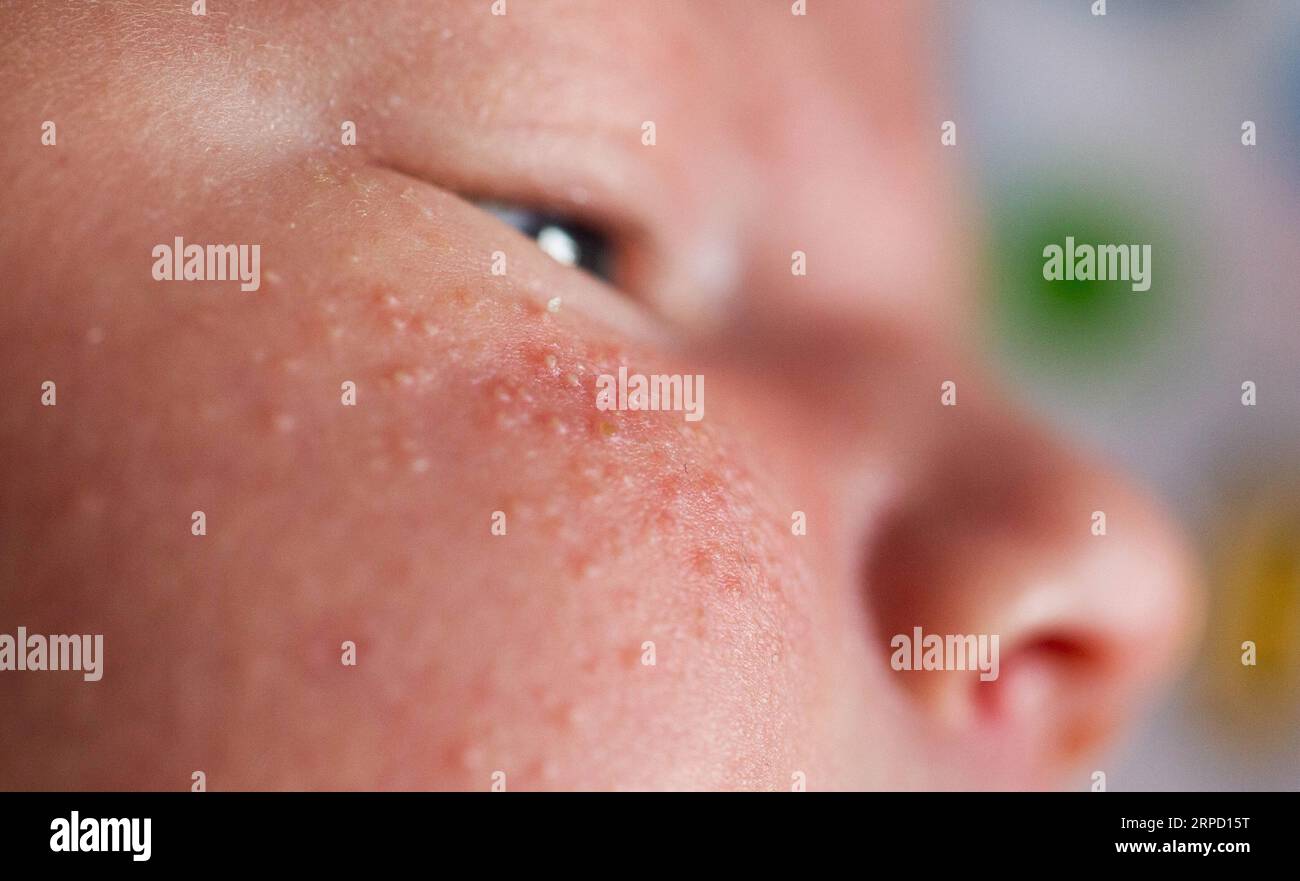 Heat Rash Baby heat-rash-baby