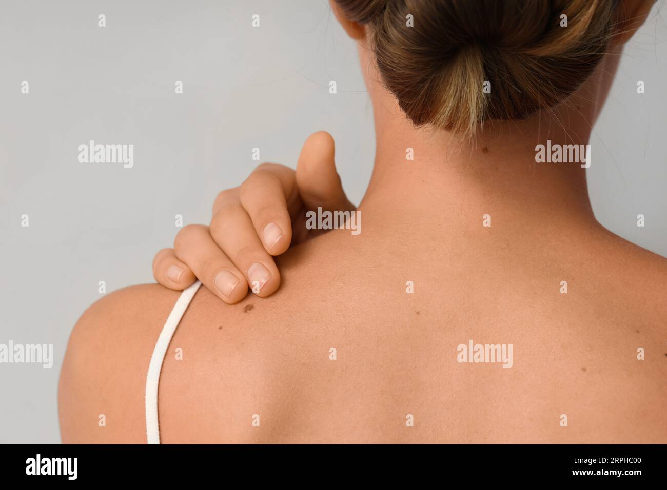 Young woman with moles on light background, back view Stock Photo - Alamy