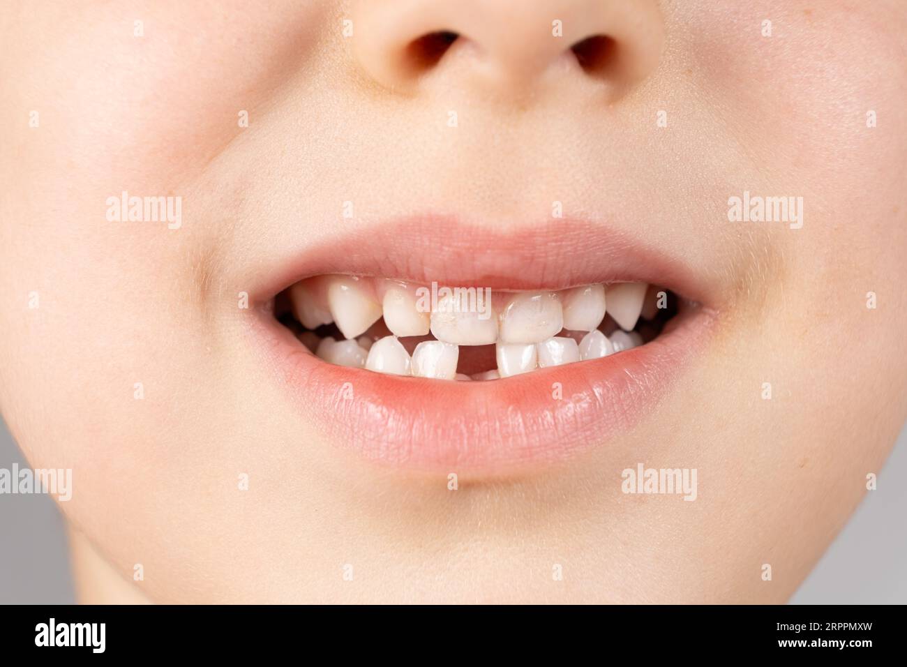 Loss of milk teeth in children. A six-year-old child shows the first ...
