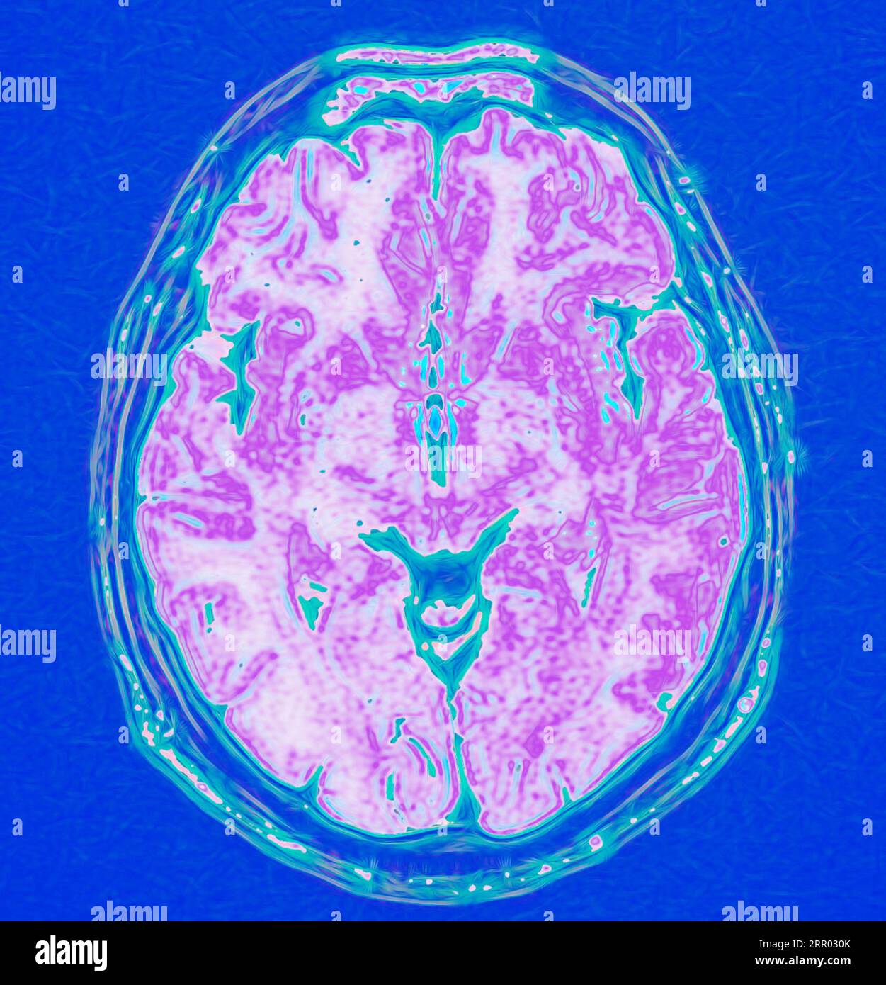 Human brain, MRI scan Stock Photo - Alamy