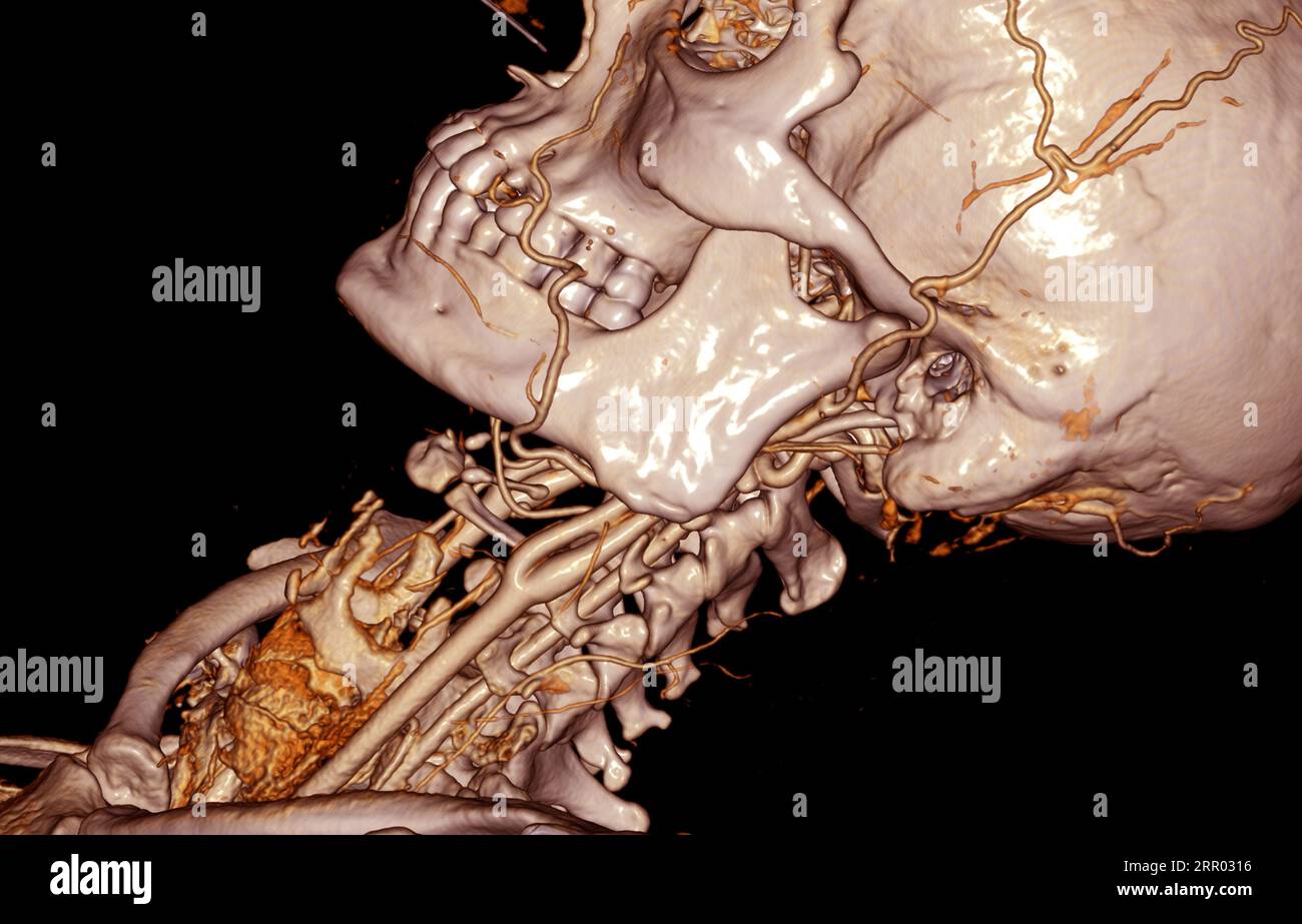 Head and neck blood vessels, CT scan Stock Photo - Alamy