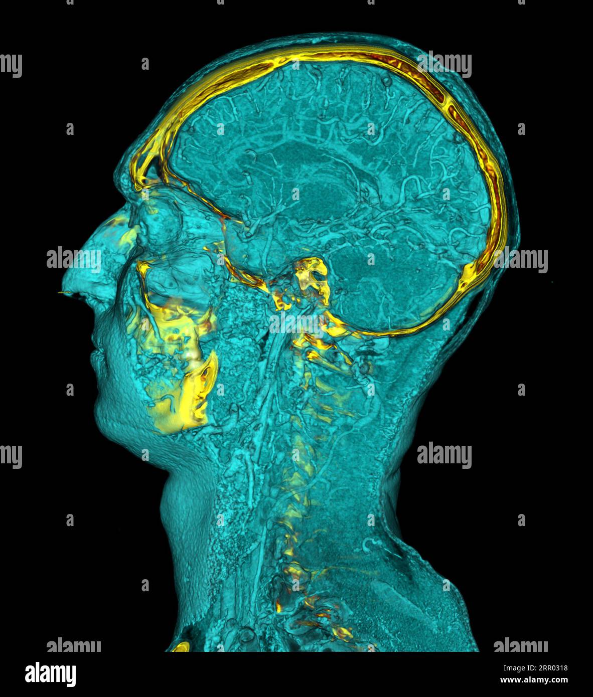 Head and neck blood vessels, CT scan Stock Photo - Alamy