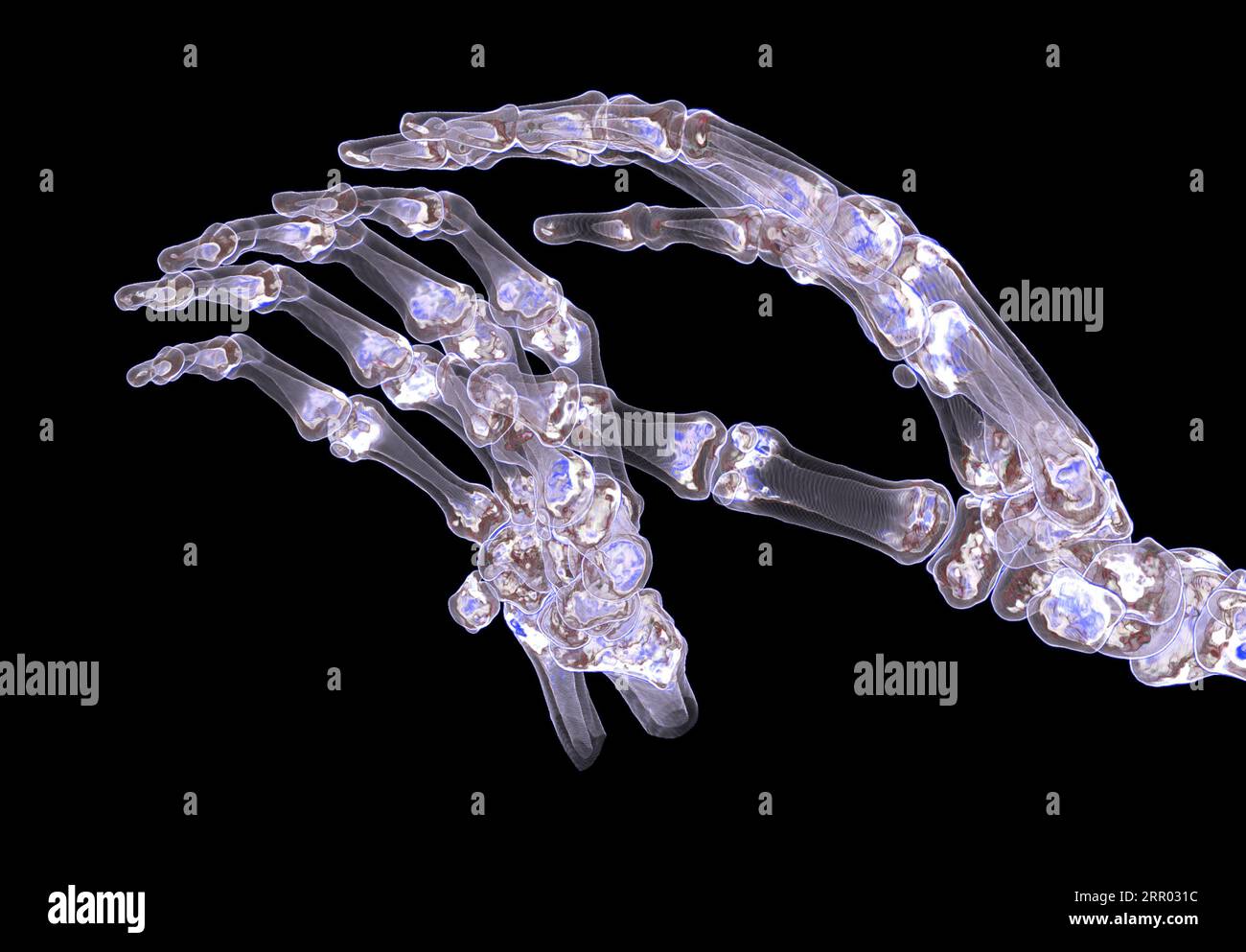 Hands and wrists, CT scan Stock Photo - Alamy