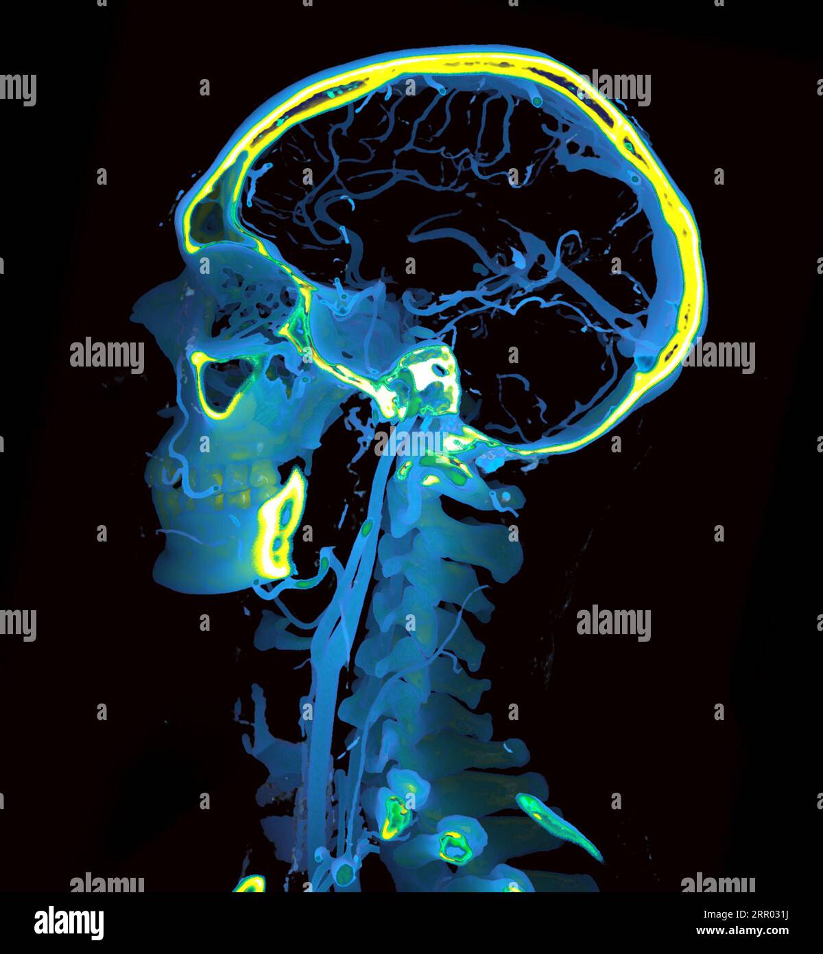 Head and neck blood vessels, CT scan Stock Photo - Alamy