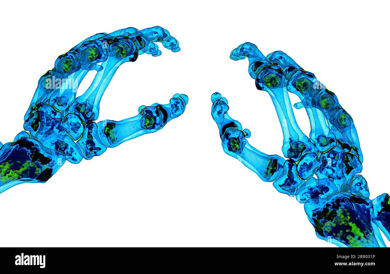 Hands and wrists, CT scan Stock Photo - Alamy