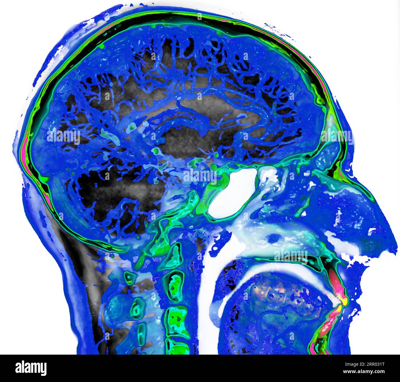 Head and brain blood vessels, CT scan Stock Photo - Alamy