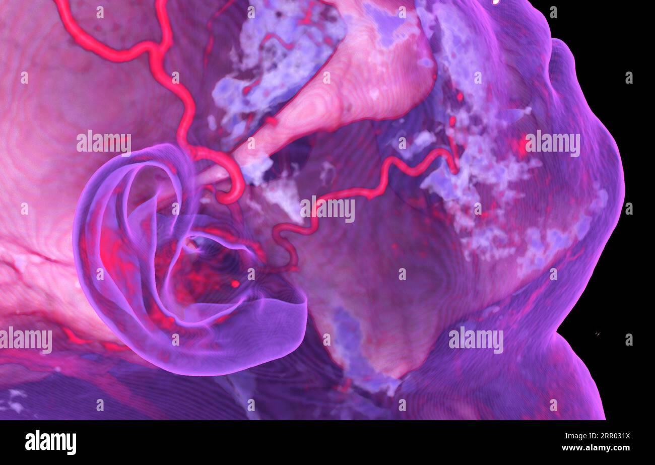Head blood vessels, CT scan Stock Photo - Alamy