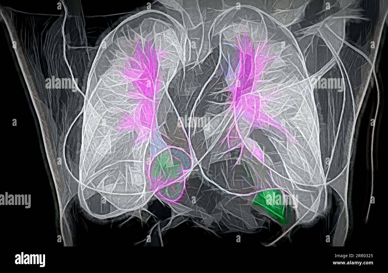 Healthy lungs, CT scan Stock Photo - Alamy
