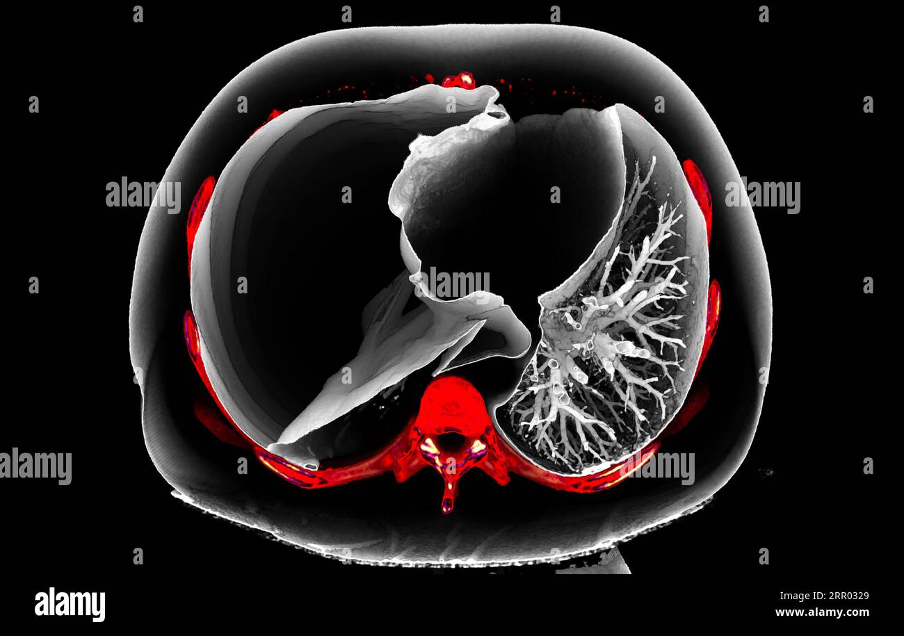 Tension pneumothorax, CT scan Stock Photo - Alamy
