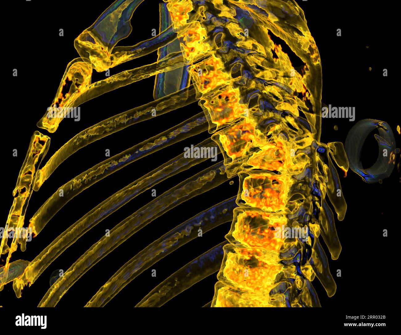 Thoracic spine fracture, CT scan Stock Photo - Alamy