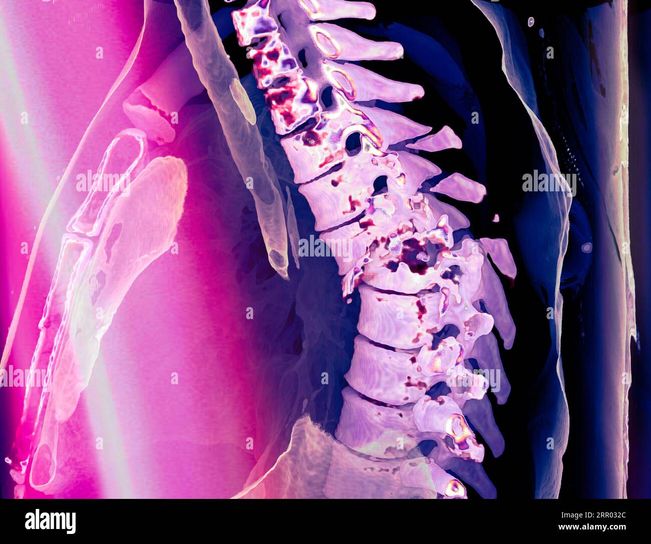 Thoracic spine fracture, CT scan Stock Photo - Alamy