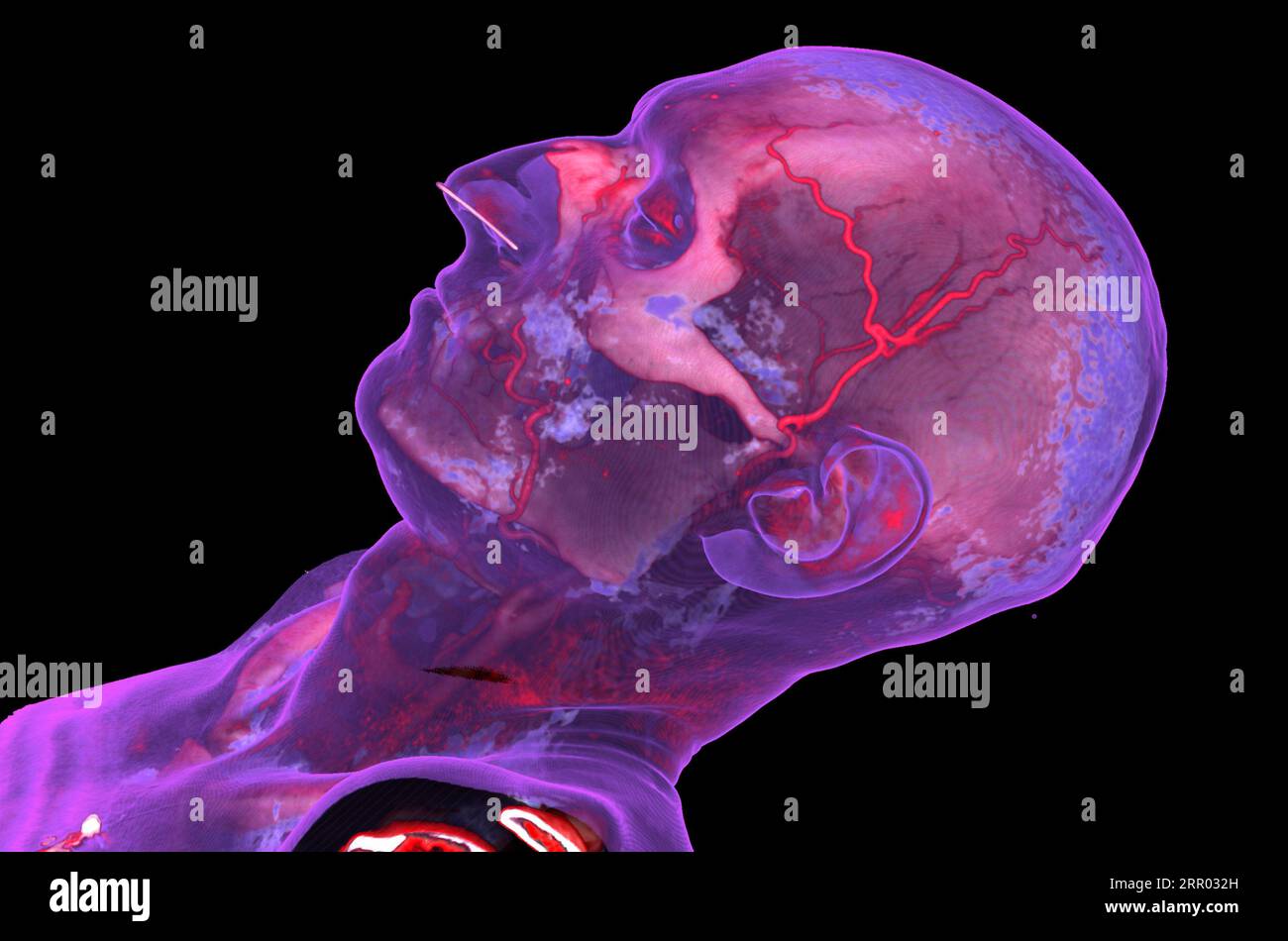 Head and neck blood vessels, CT scan Stock Photo - Alamy