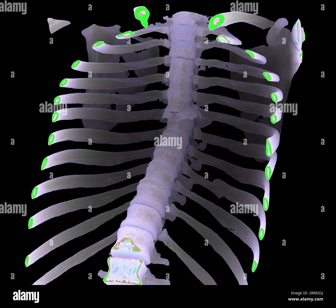 Thoracic spine fracture, CT scan Stock Photo - Alamy