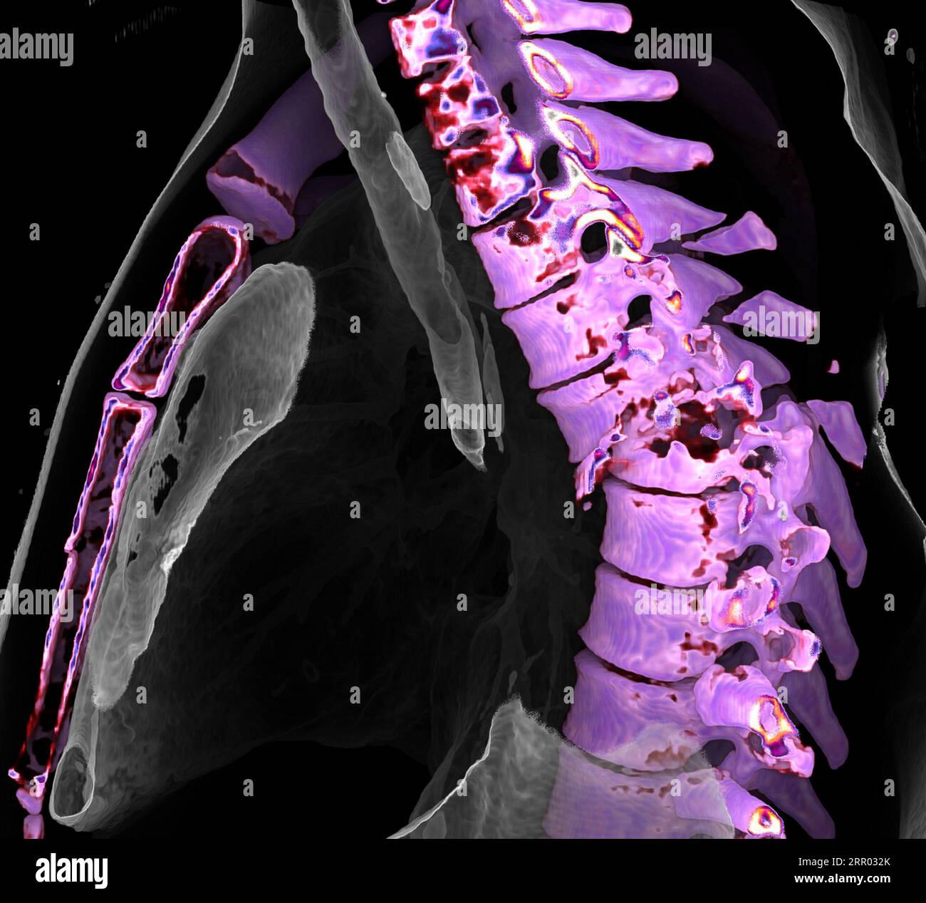 Thoracic spine fracture, CT scan Stock Photo - Alamy