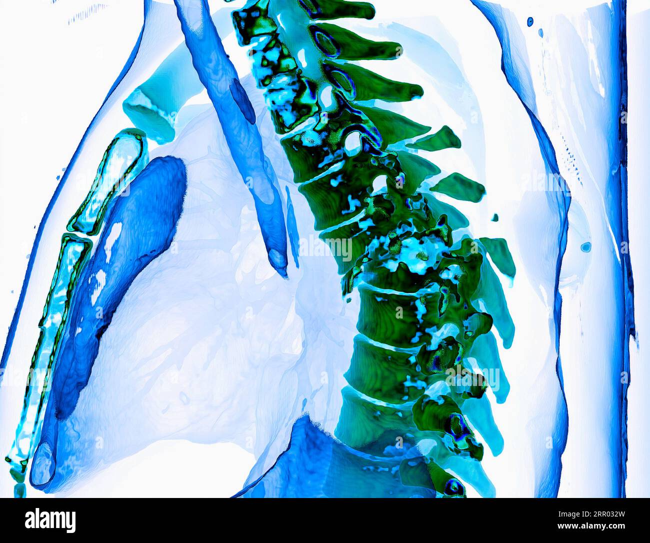 Thoracic spine fracture, CT scan Stock Photo - Alamy